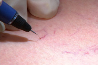 vein-wave – LONDON & SURREY VEINS